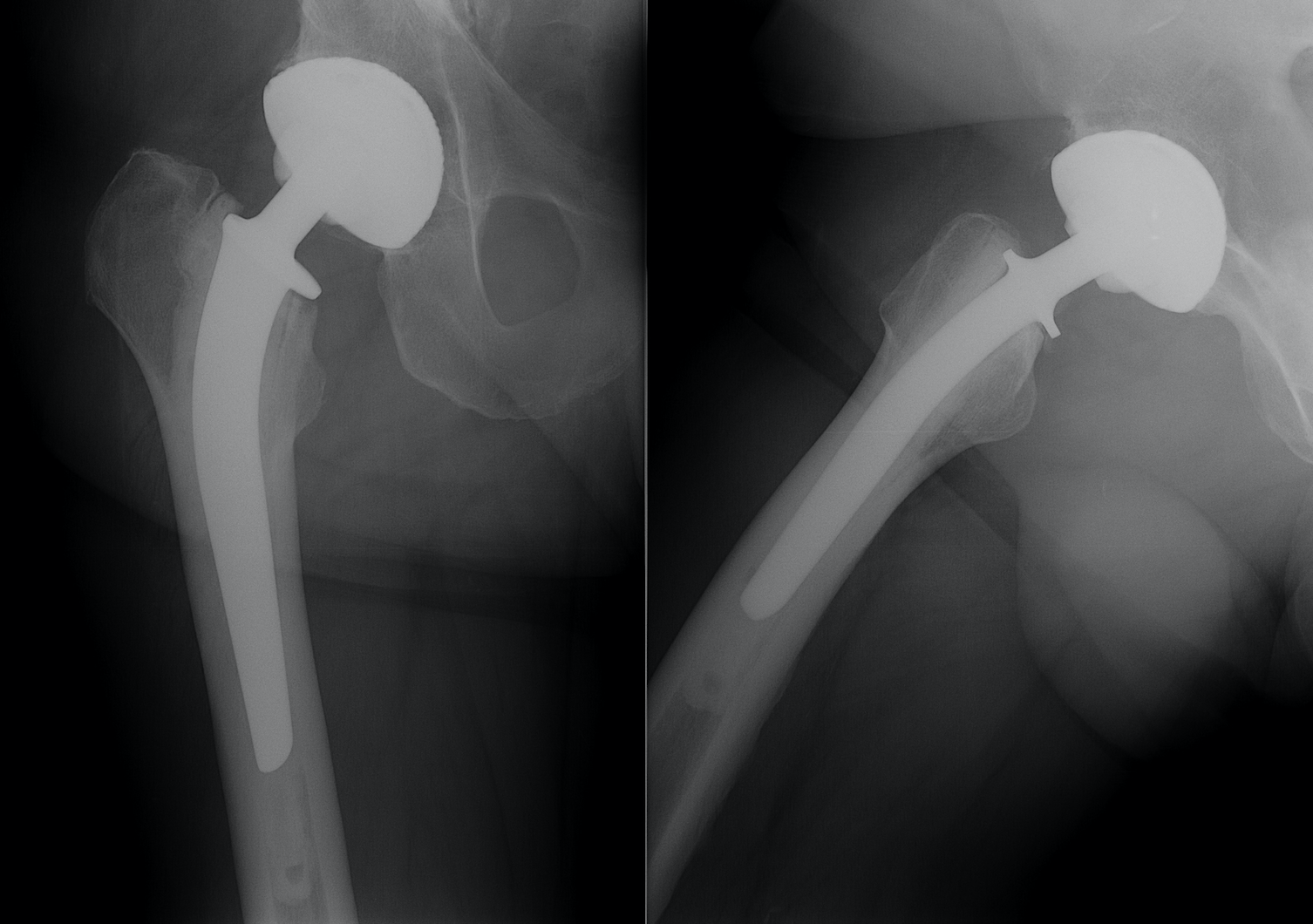 Syndrome du psoas après prothèse totale de hanche - ISCO - Institut ...