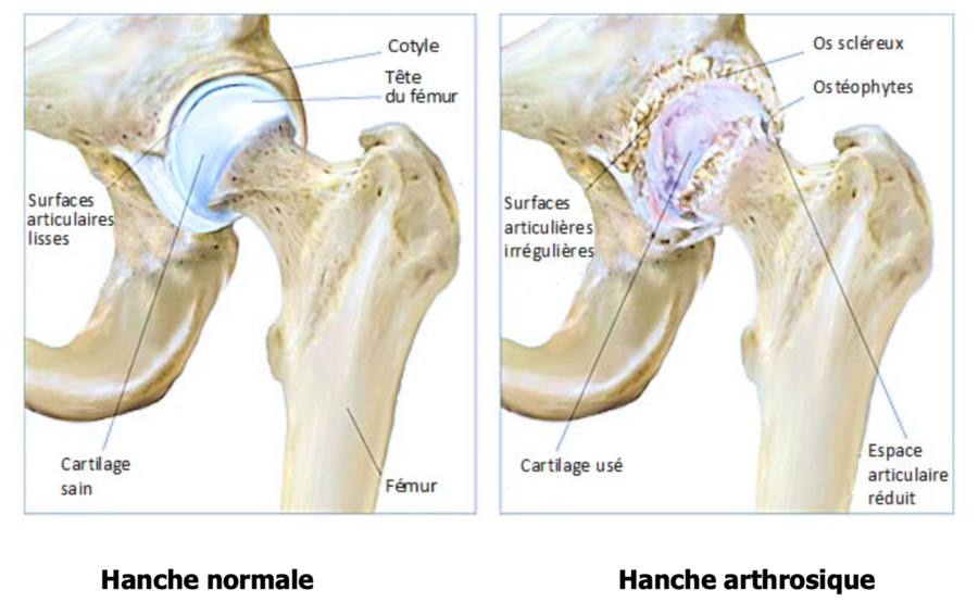 Arthrose de la hanche ou coxarthrose - ISCO - Institut Spécialisé de ...