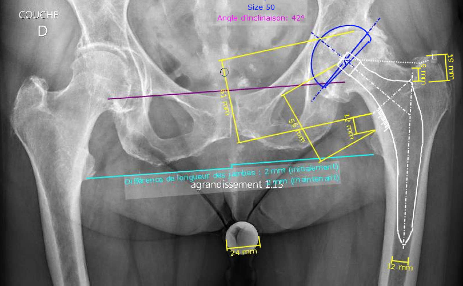 Arthrose de la hanche ou coxarthrose - ISCO - Institut Spécialisé de ...