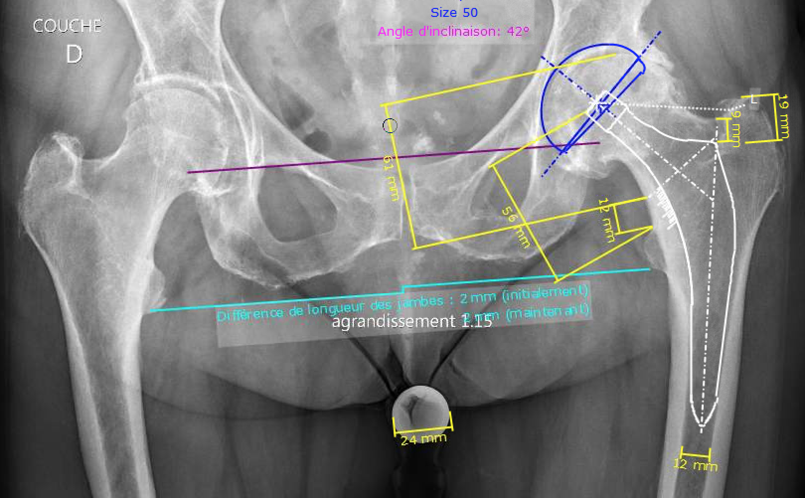Arthrose de la hanche ou coxarthrose - ISCO - Institut Spécialisé de ...