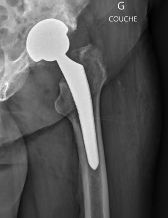 Arthrose de la hanche ou coxarthrose - ISCO - Institut Spécialisé de ...
