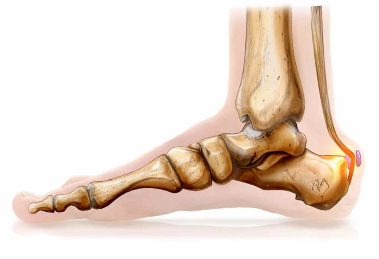 Maladie de Haglund - ISCO - Institut Spécialisé de Chirurgie ...