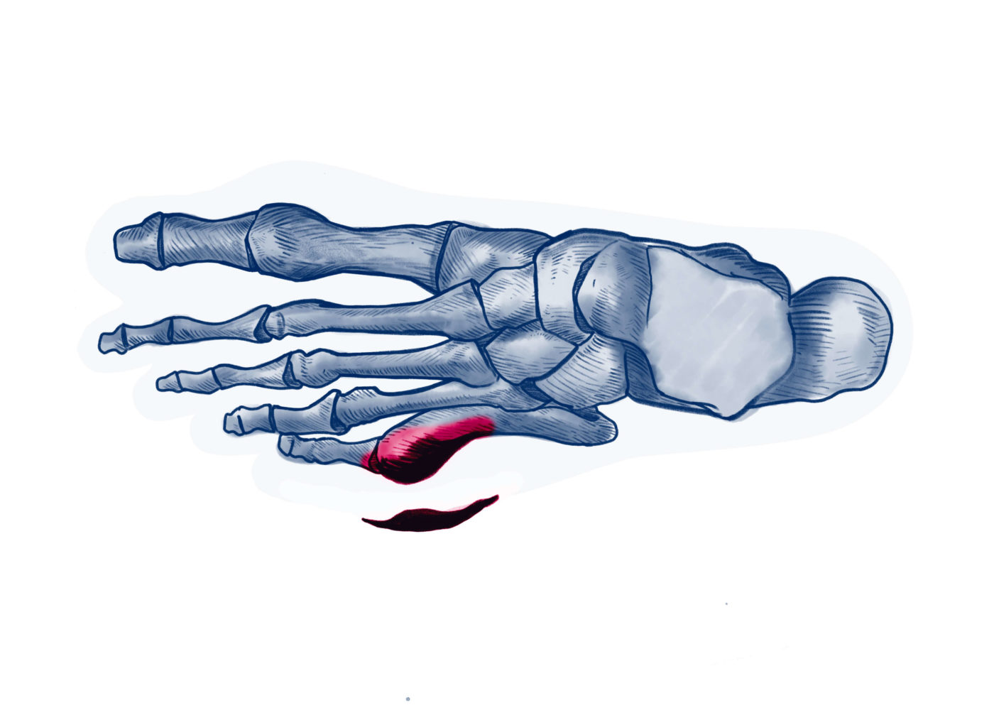 Pathologies Pied - ISCO - Institut Spécialisé de Chirurgie Orthopédique ...