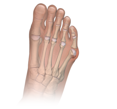 Quintus varus - ISCO - Institut Spécialisé de Chirurgie Orthopédique à ...