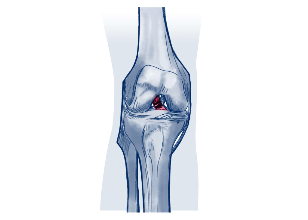 Pathologies Genou - ISCO - Institut Spécialisé de Chirurgie ...